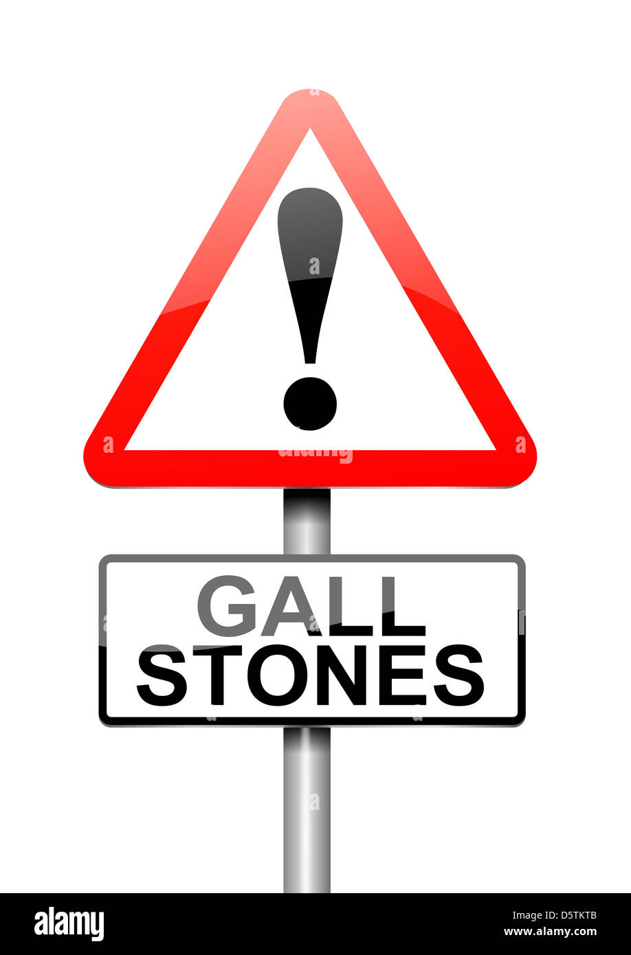 Gallbladder stones hi-res stock photography and images - Alamy