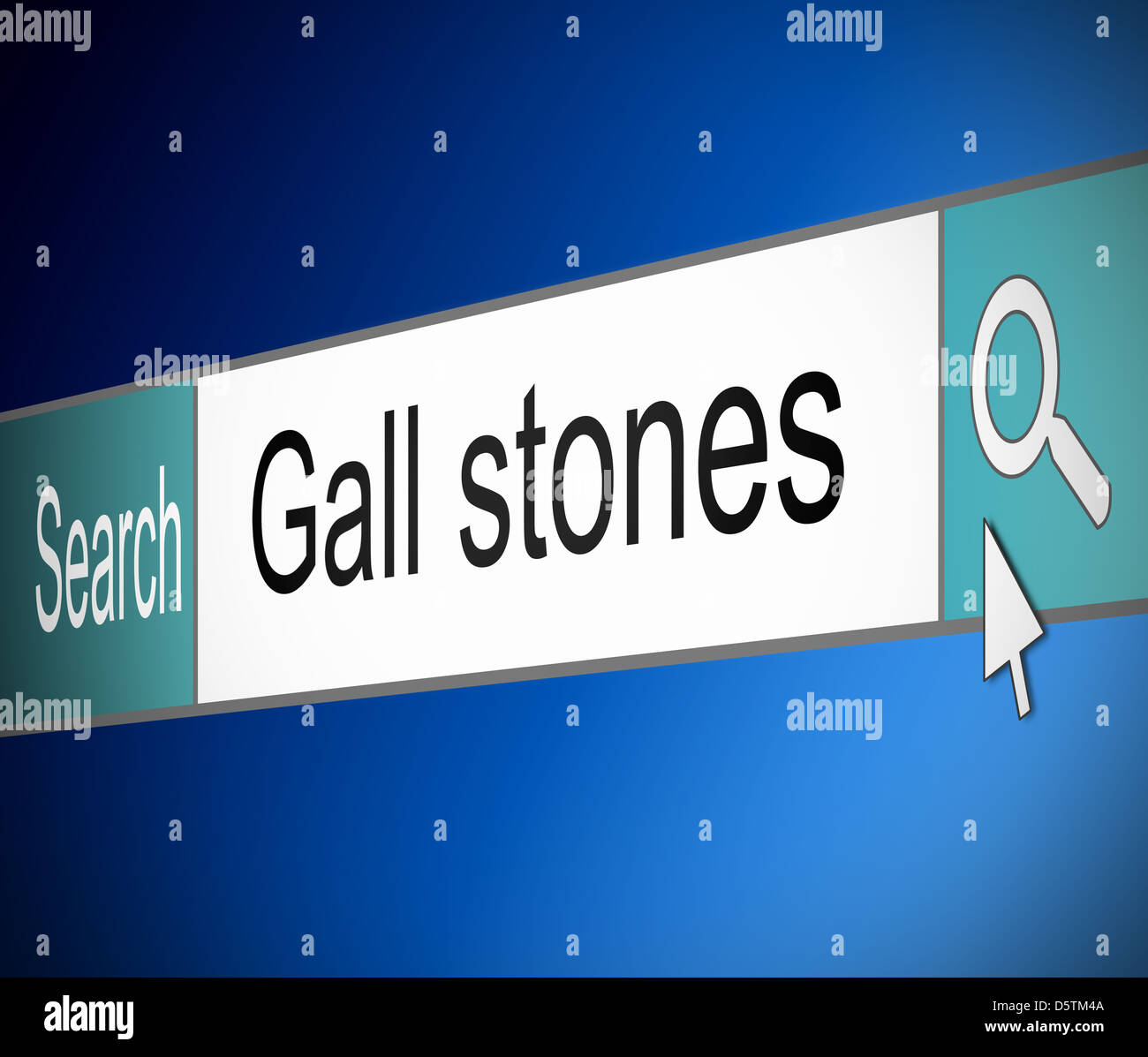 Gall stones hi-res stock photography and images - Alamy