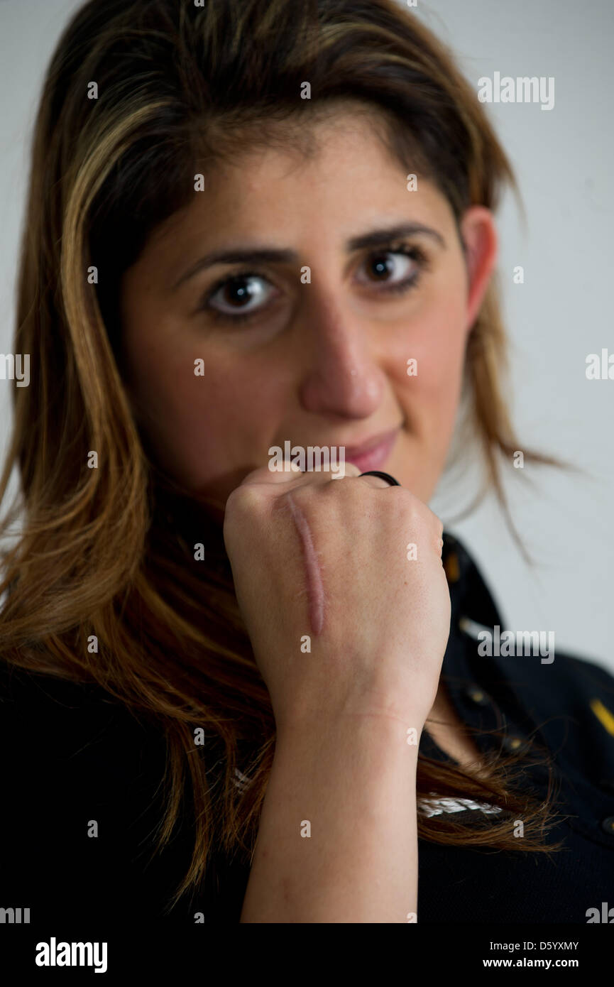 Boxer Rola El-Halabi shows a scar on the back of her hand after a press ...