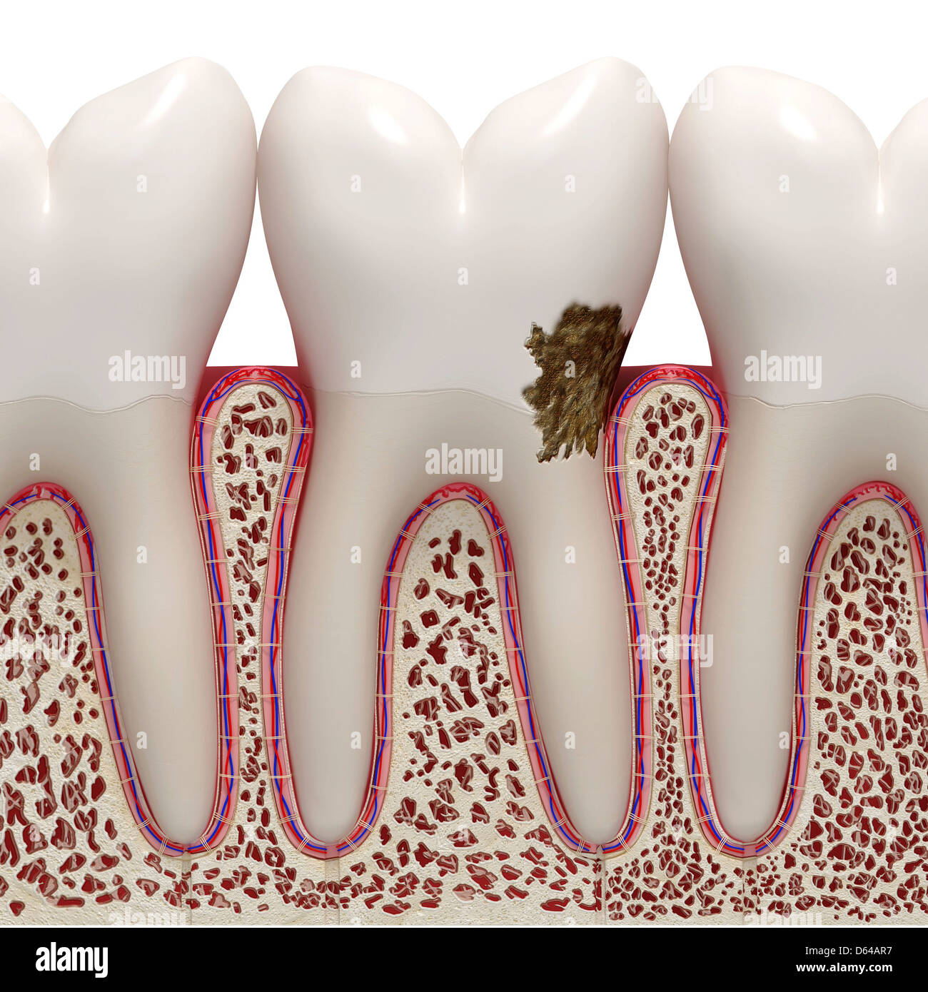 Dental plaque hi-res stock photography and images - Alamy