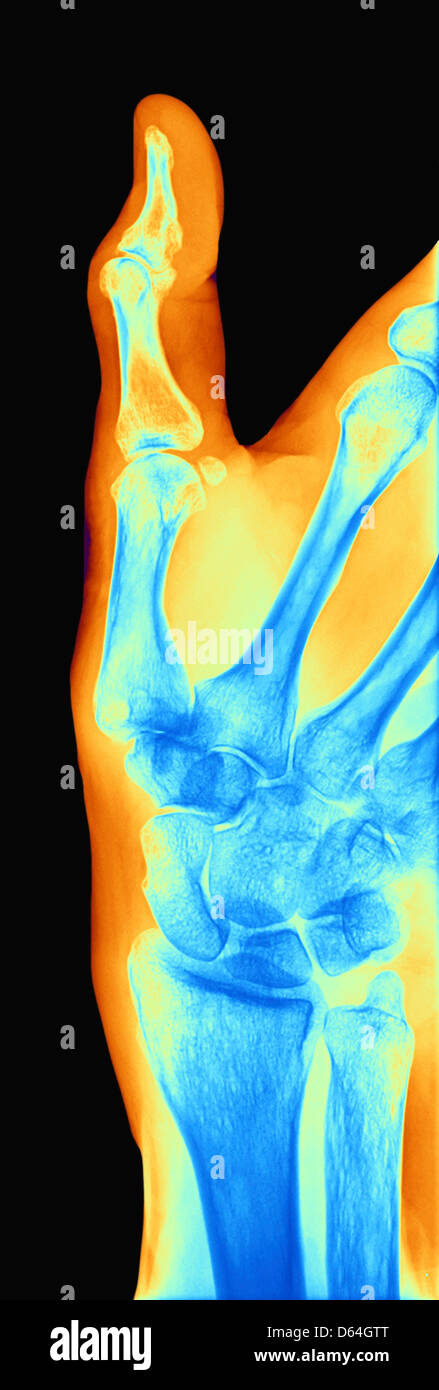 X ray hands arthritis hi-res stock photography and images - Alamy