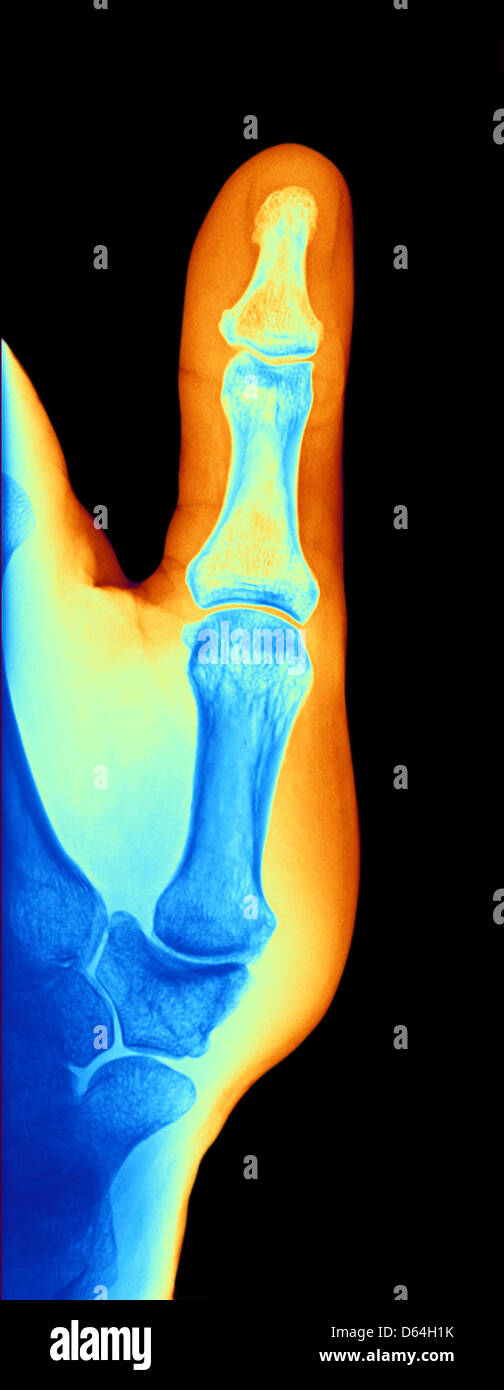 Osteoarthrosis hi-res stock photography and images - Alamy