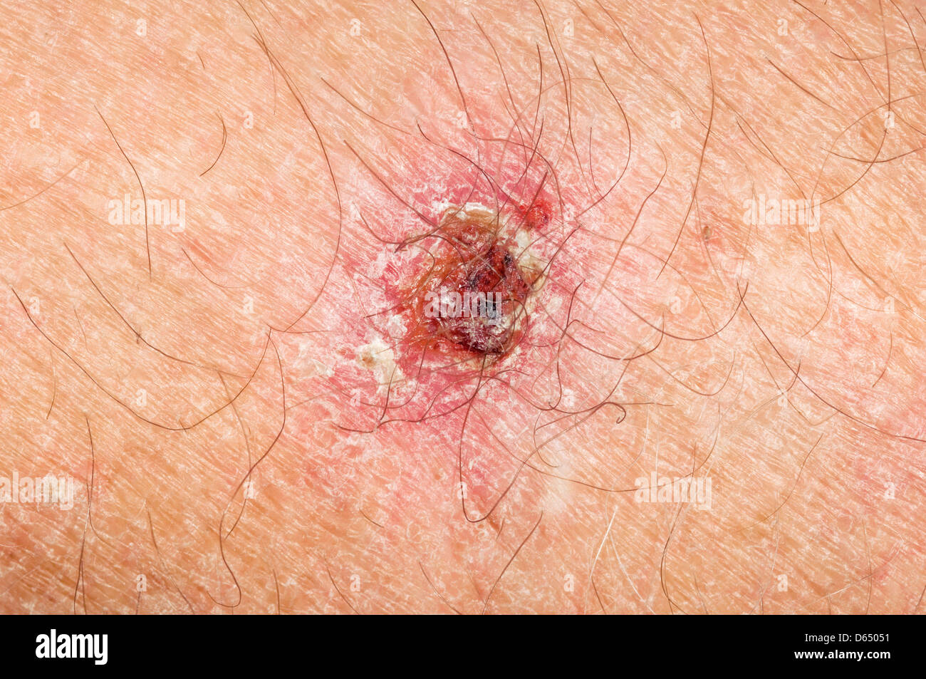 Elderly skin cancer hi-res stock photography and images - Alamy