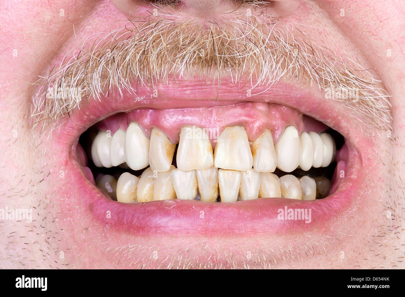 Yellowest Teeth In The World