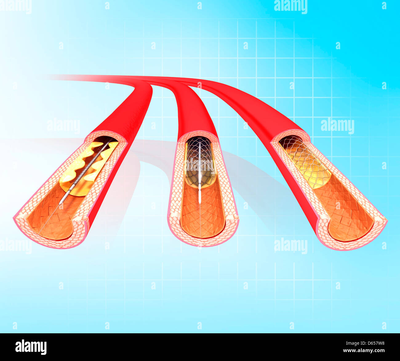 Balloon angioplasty hi-res stock photography and images - Alamy