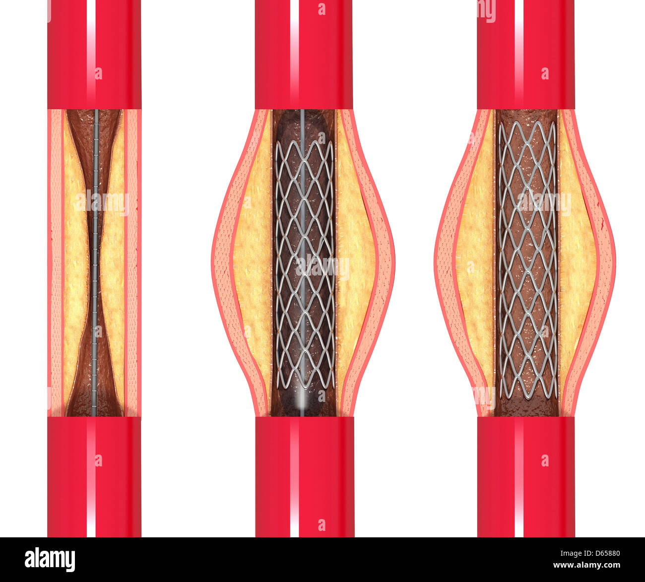 Angioplasty hi-res stock photography and images - Alamy