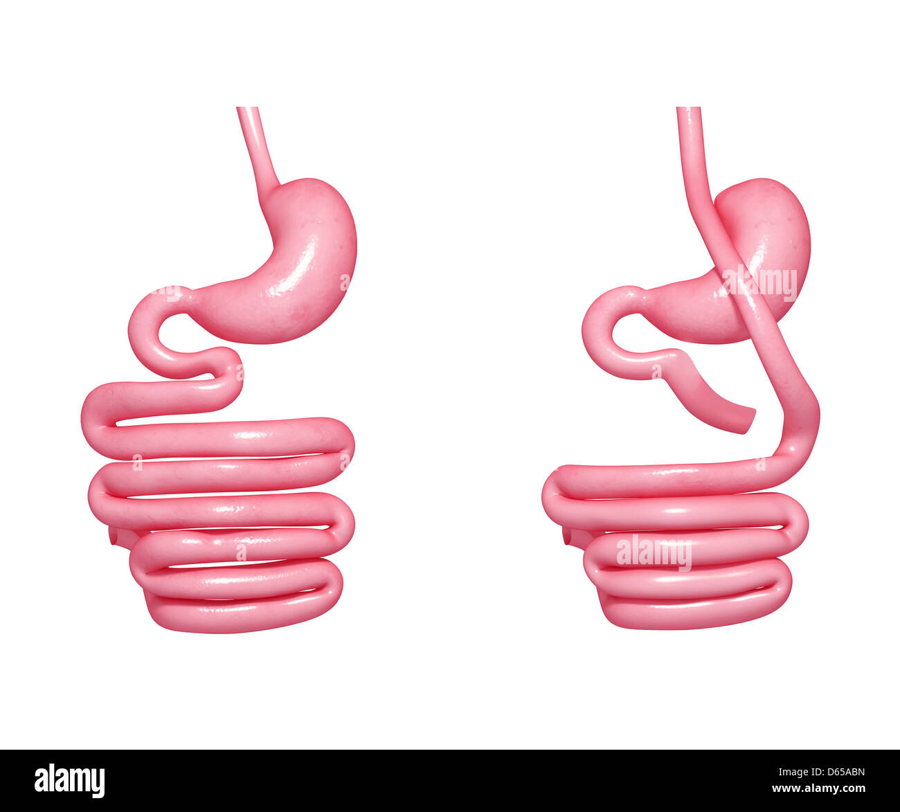 Bypass operation hi-res stock photography and images - Alamy