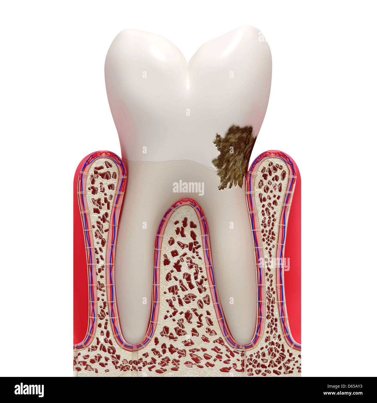 Dental plaque hi-res stock photography and images - Alamy