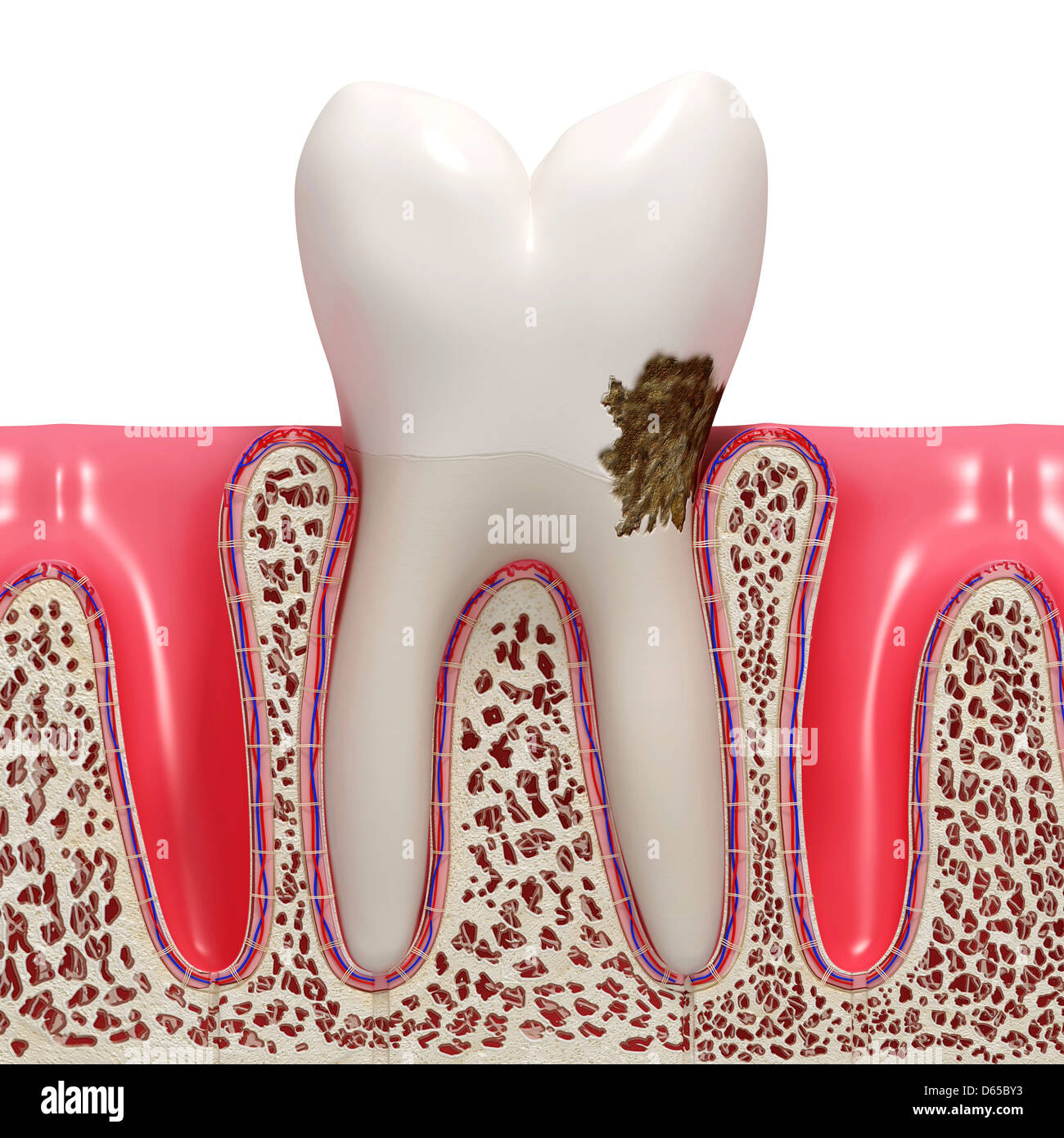 Dental plaque teeth hi-res stock photography and images - Alamy