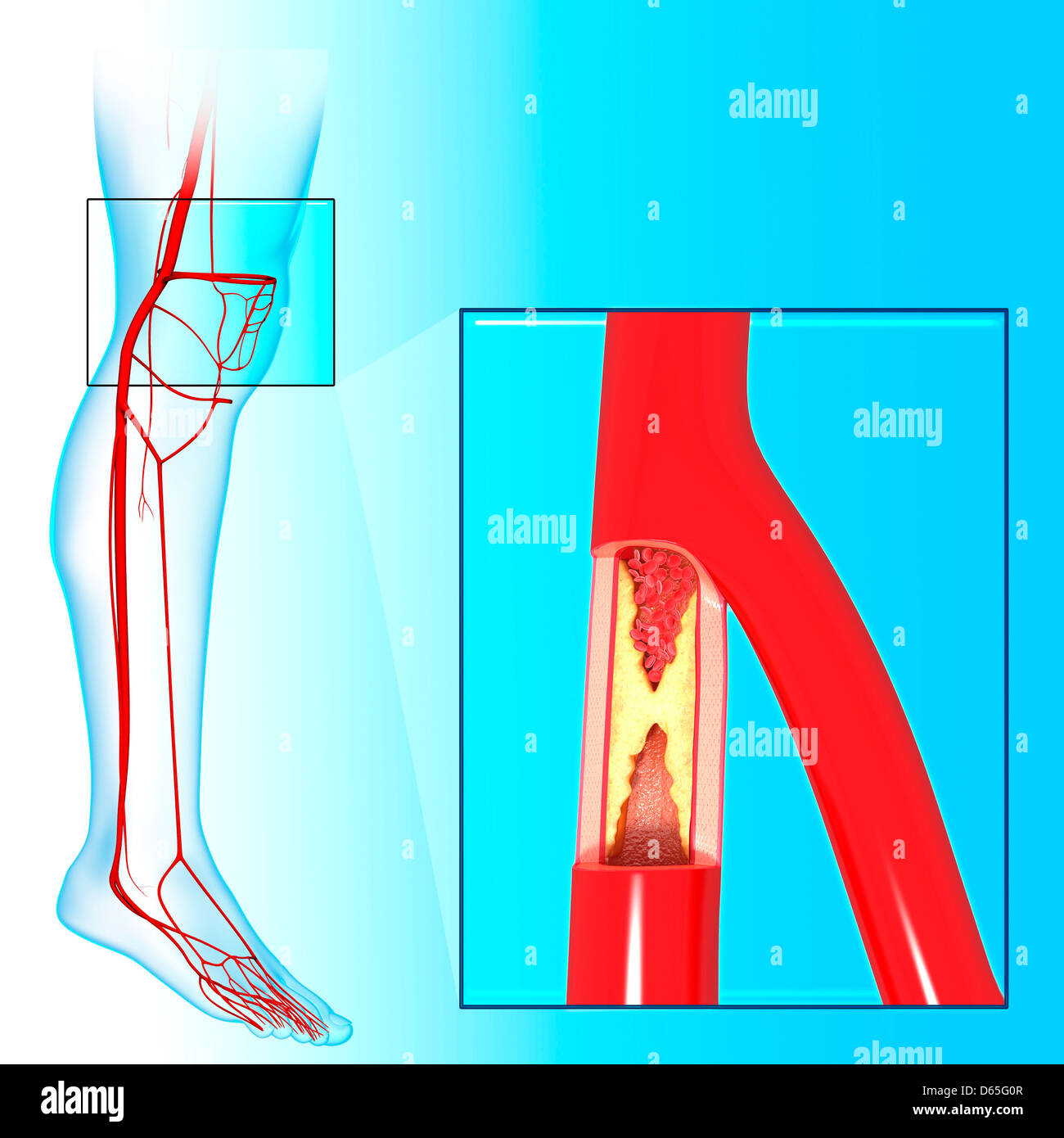 Atherosclerosis leg artery hi-res stock photography and images - Alamy