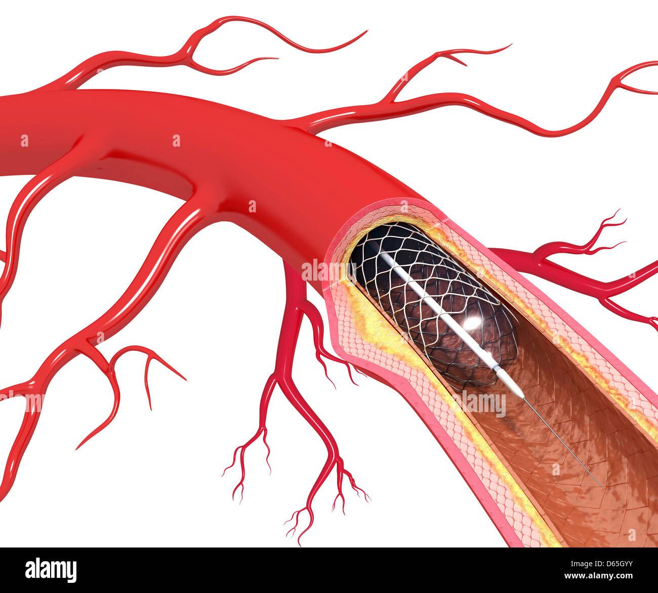 Balloon angioplasty hi-res stock photography and images - Alamy