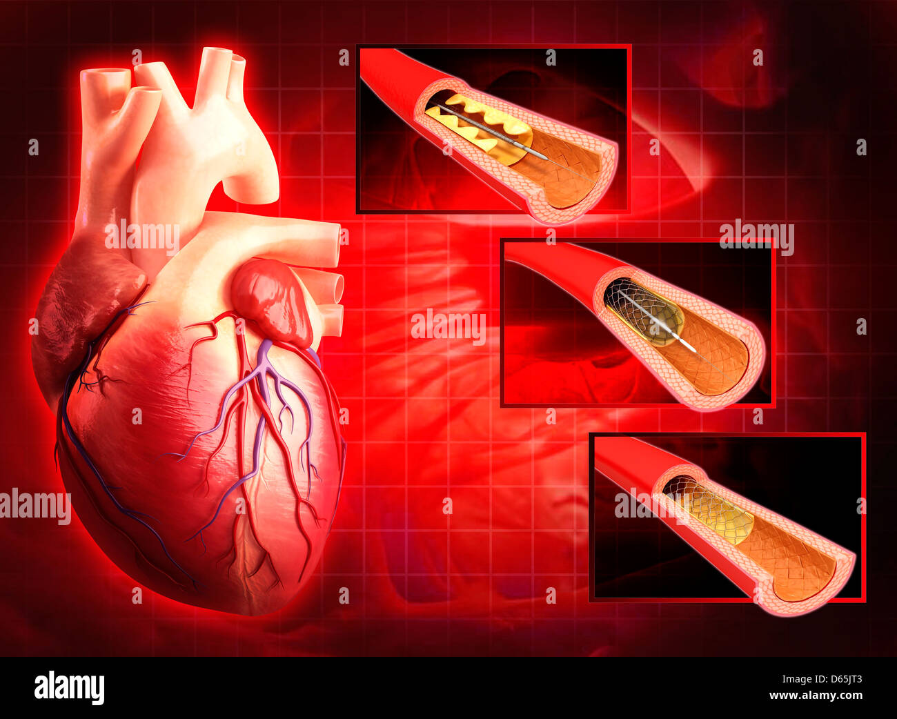 Angioplasty hi-res stock photography and images - Alamy
