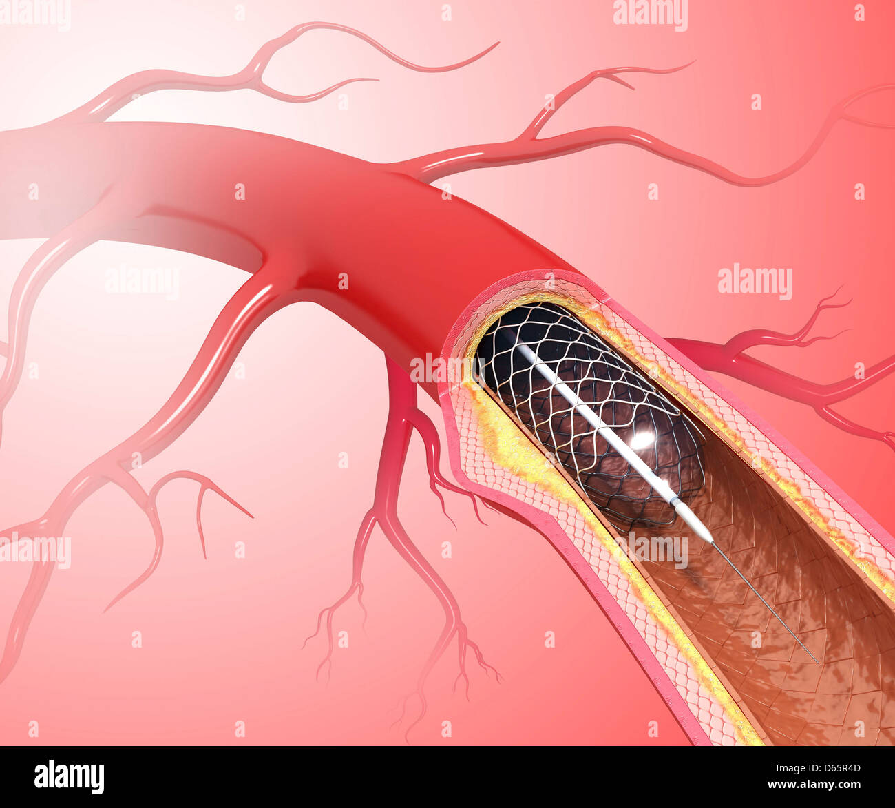 Angioplasty hi-res stock photography and images - Alamy