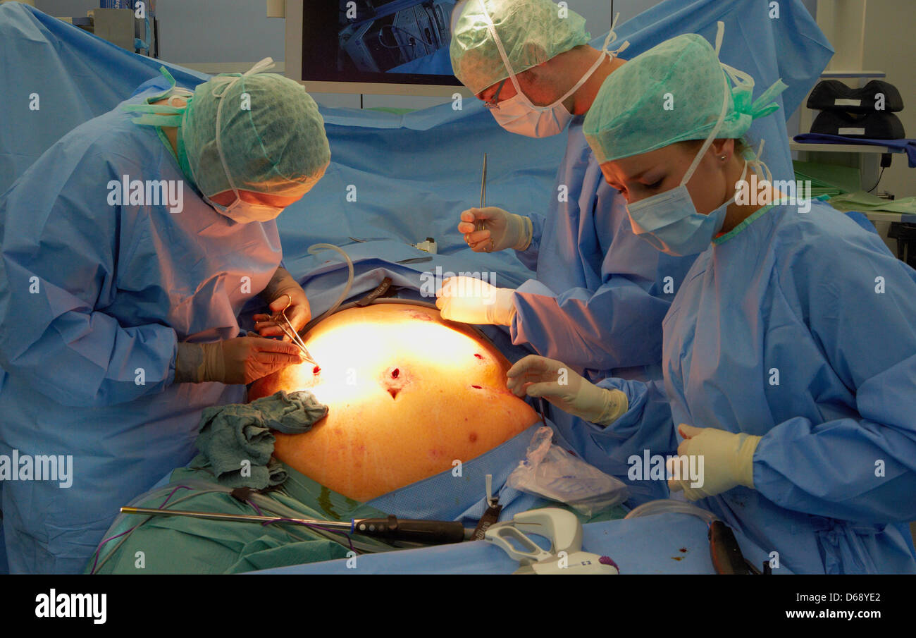 Doctors operate to install a laparoscopic adjustable gastric band at ...