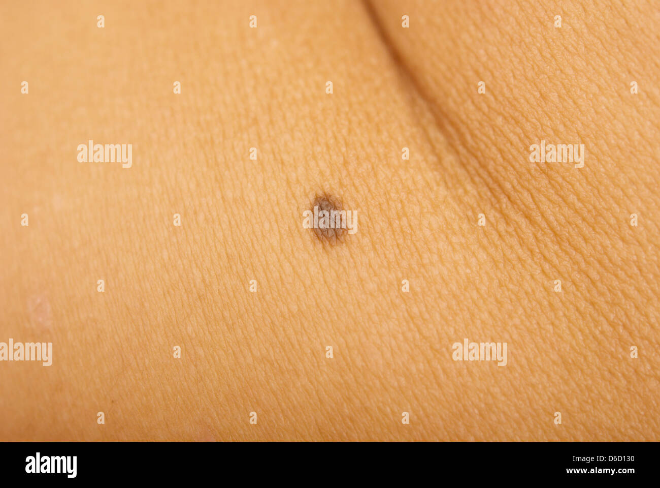 Human mole hi-res stock photography and images - Alamy