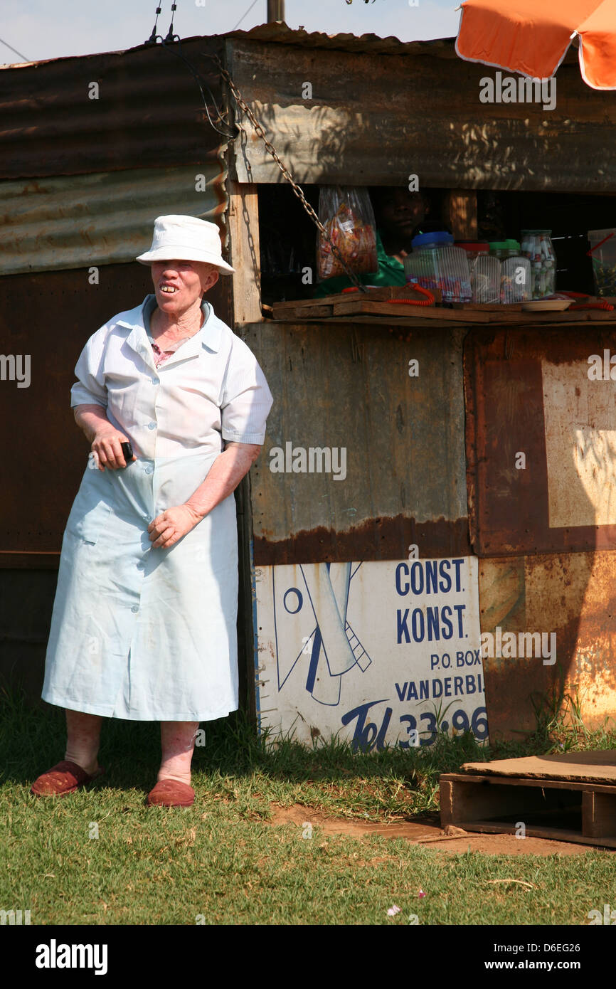 An African albino woman stands outside a tin shack in a rural setting ...