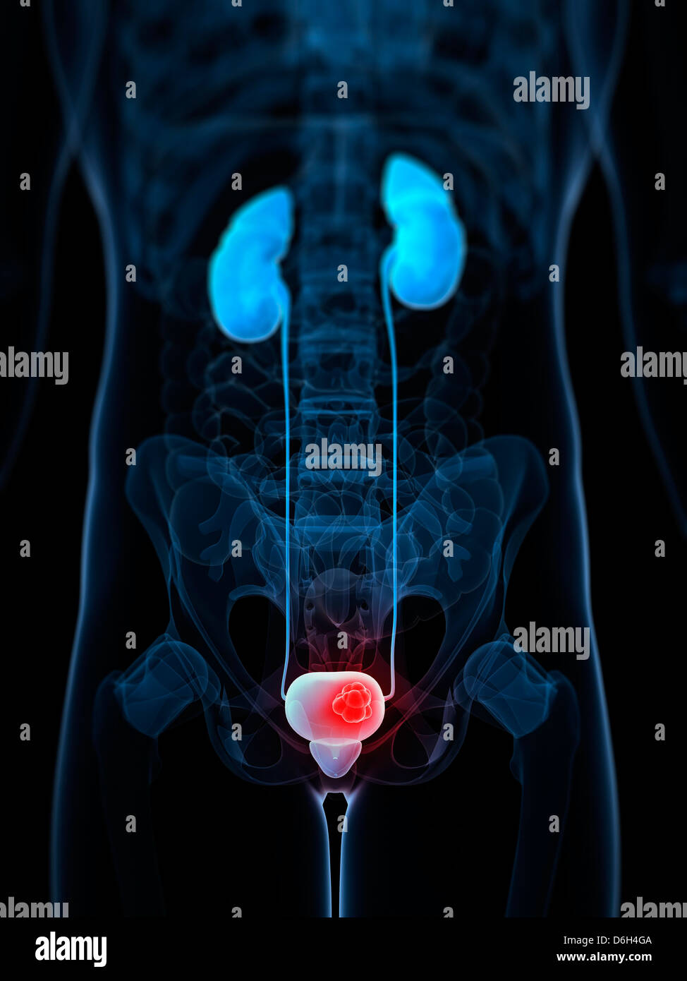 Bladder cancer hi-res stock photography and images - Alamy