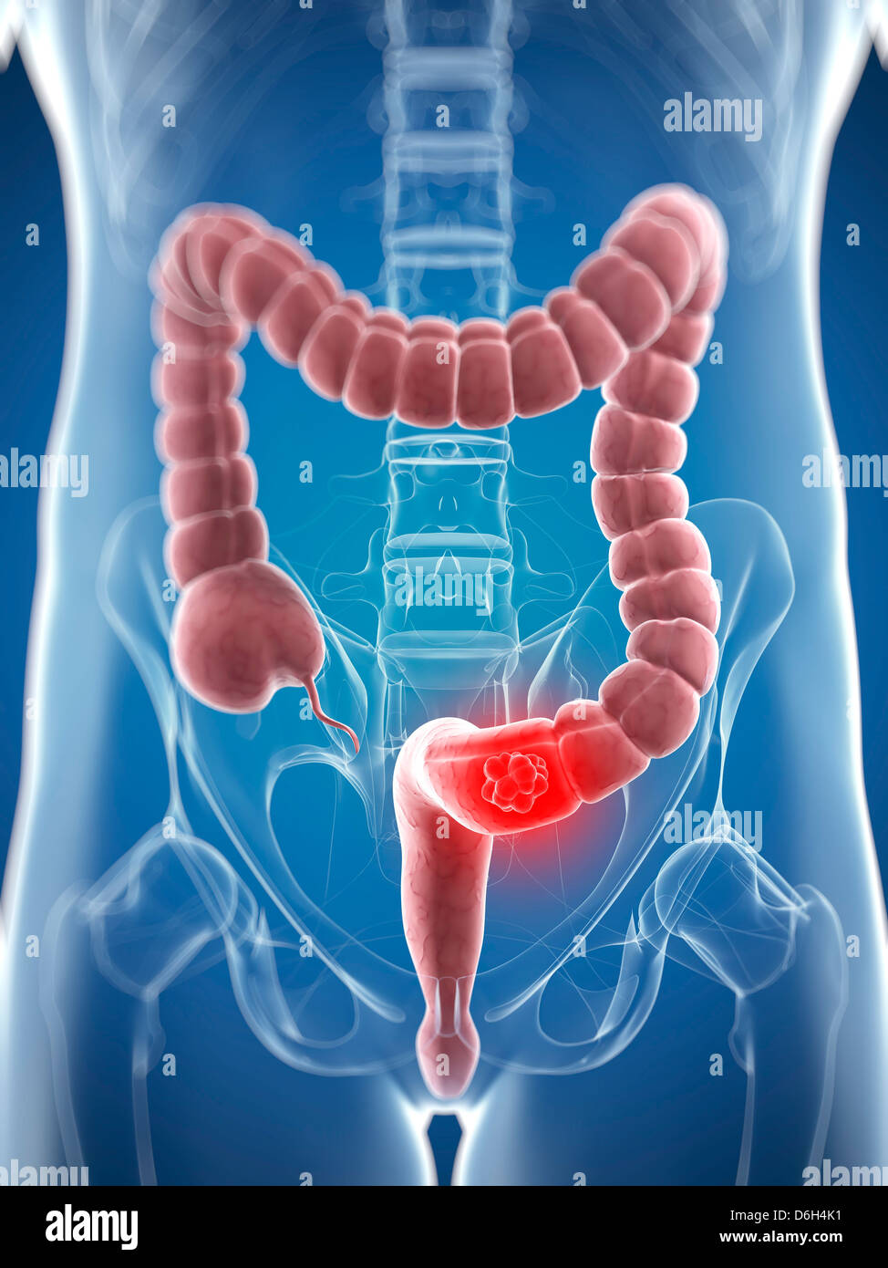 Abnormal Colon High Resolution Stock Photography and Images - Alamy