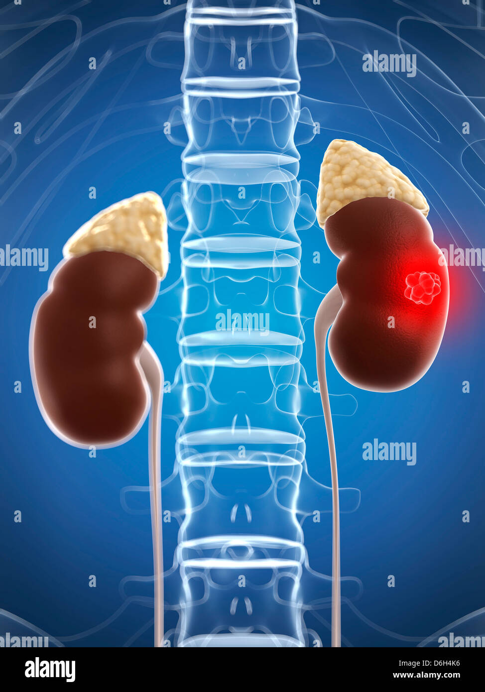 Kidney cancer hi-res stock photography and images - Alamy