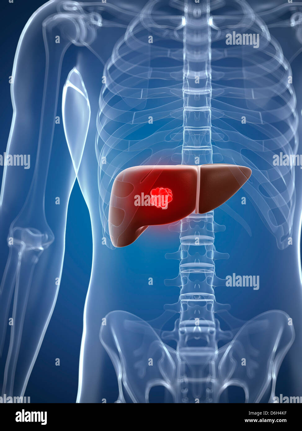 Liver cancer hi-res stock photography and images - Alamy