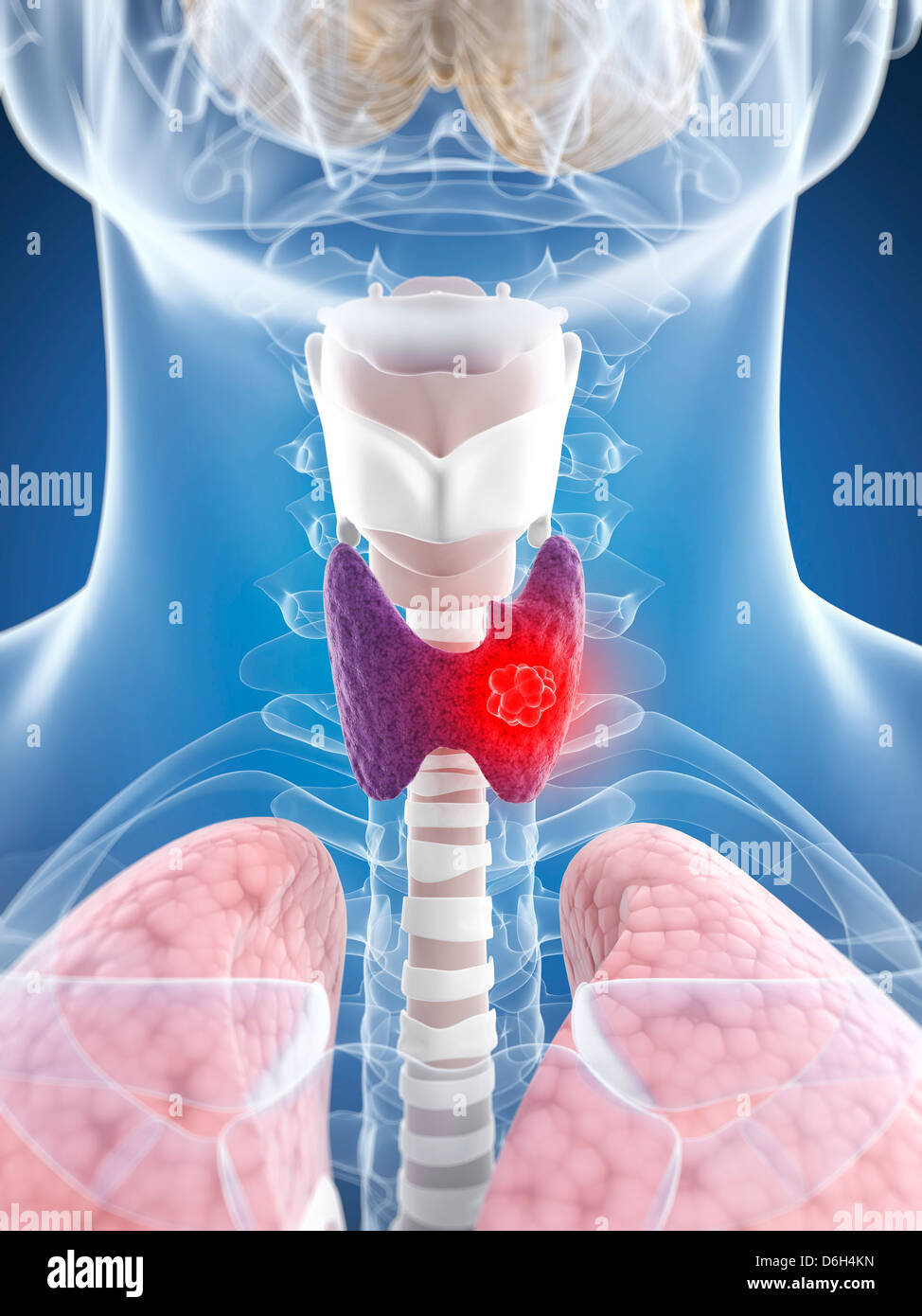 Thyroid cancer, artwork Stock Photo - Alamy