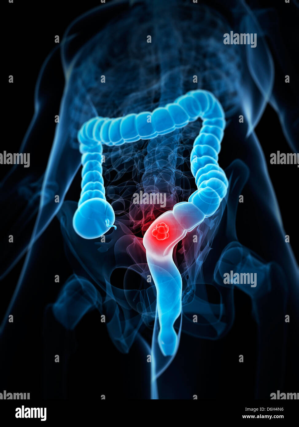 Abnormal Colon High Resolution Stock Photography and Images - Alamy