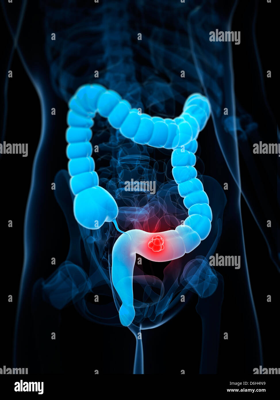 Abnormal Colon High Resolution Stock Photography and Images - Alamy