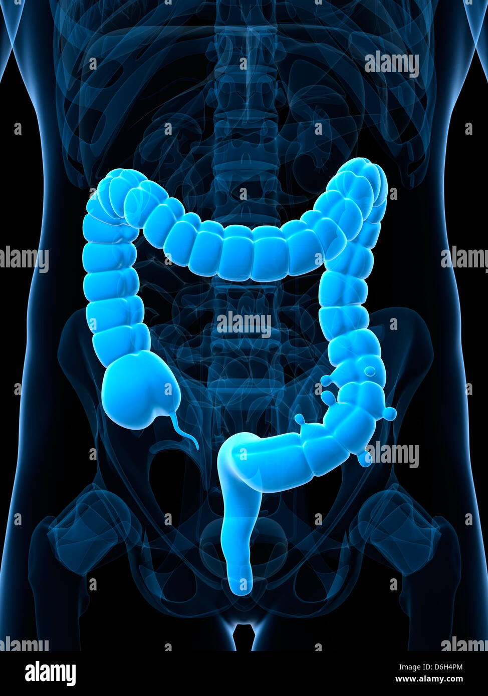 Diverticulosis of colon hi-res stock photography and images - Alamy
