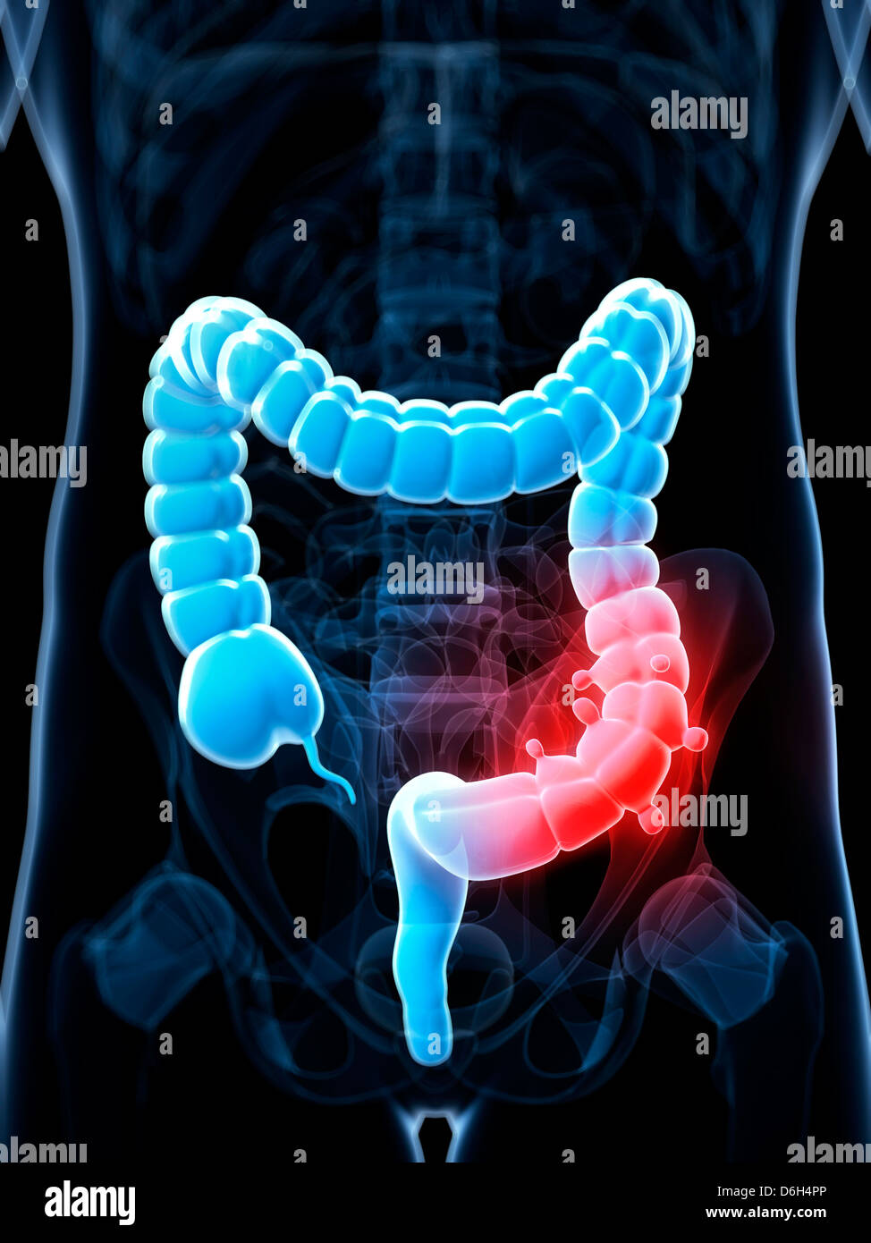 Diverticulosis of colon hi-res stock photography and images - Alamy