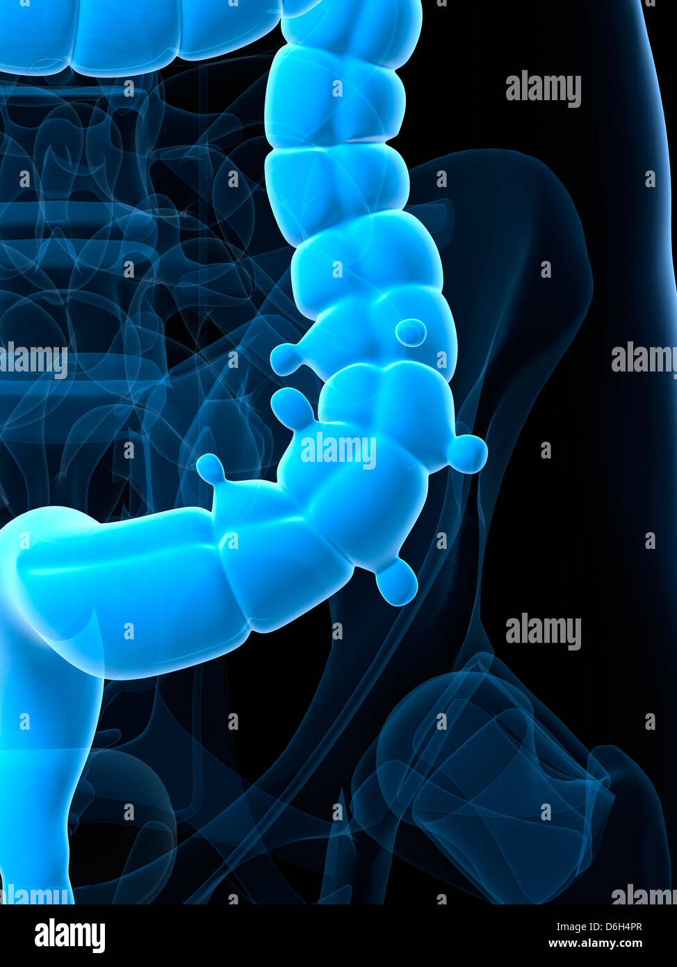 Diverticulosis of colon hi-res stock photography and images - Alamy