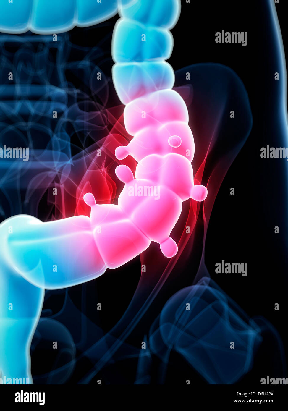 Diverticulosis of colon hi-res stock photography and images - Alamy