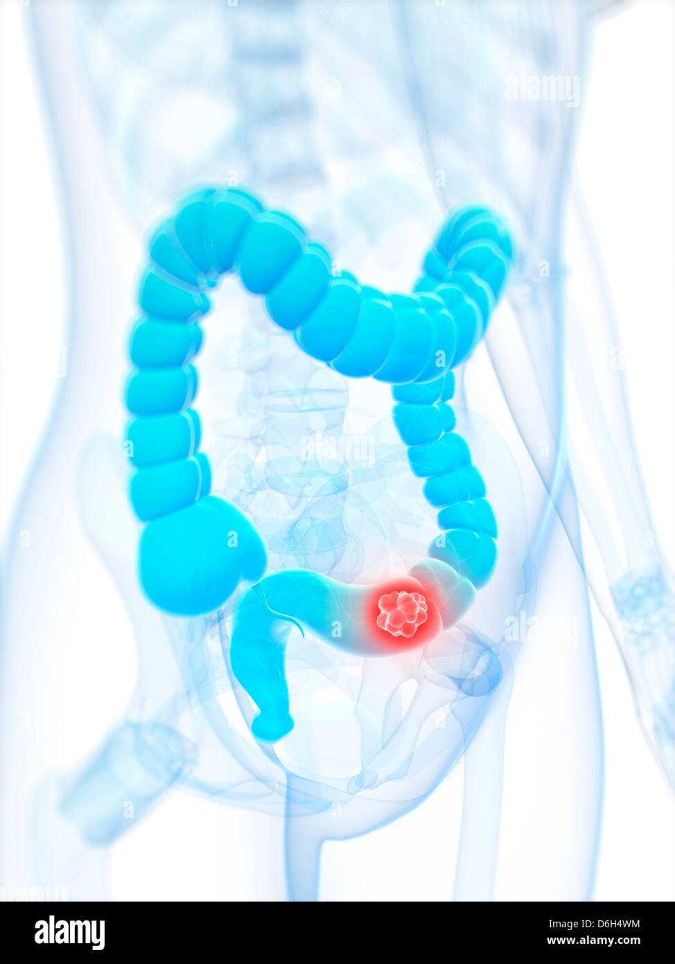 Colon cancer, artwork Stock Photo - Alamy