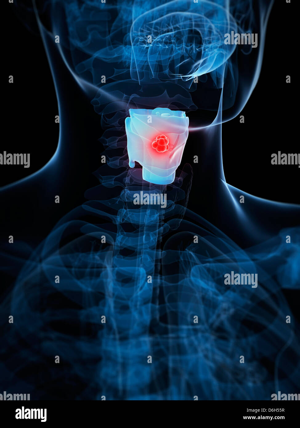 Larynx cancer hi-res stock photography and images - Alamy