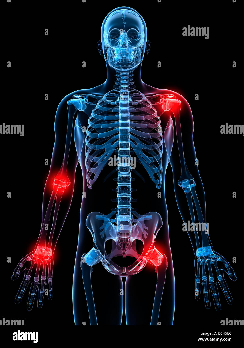 Joint pain, conceptual artwork Stock Photo - Alamy