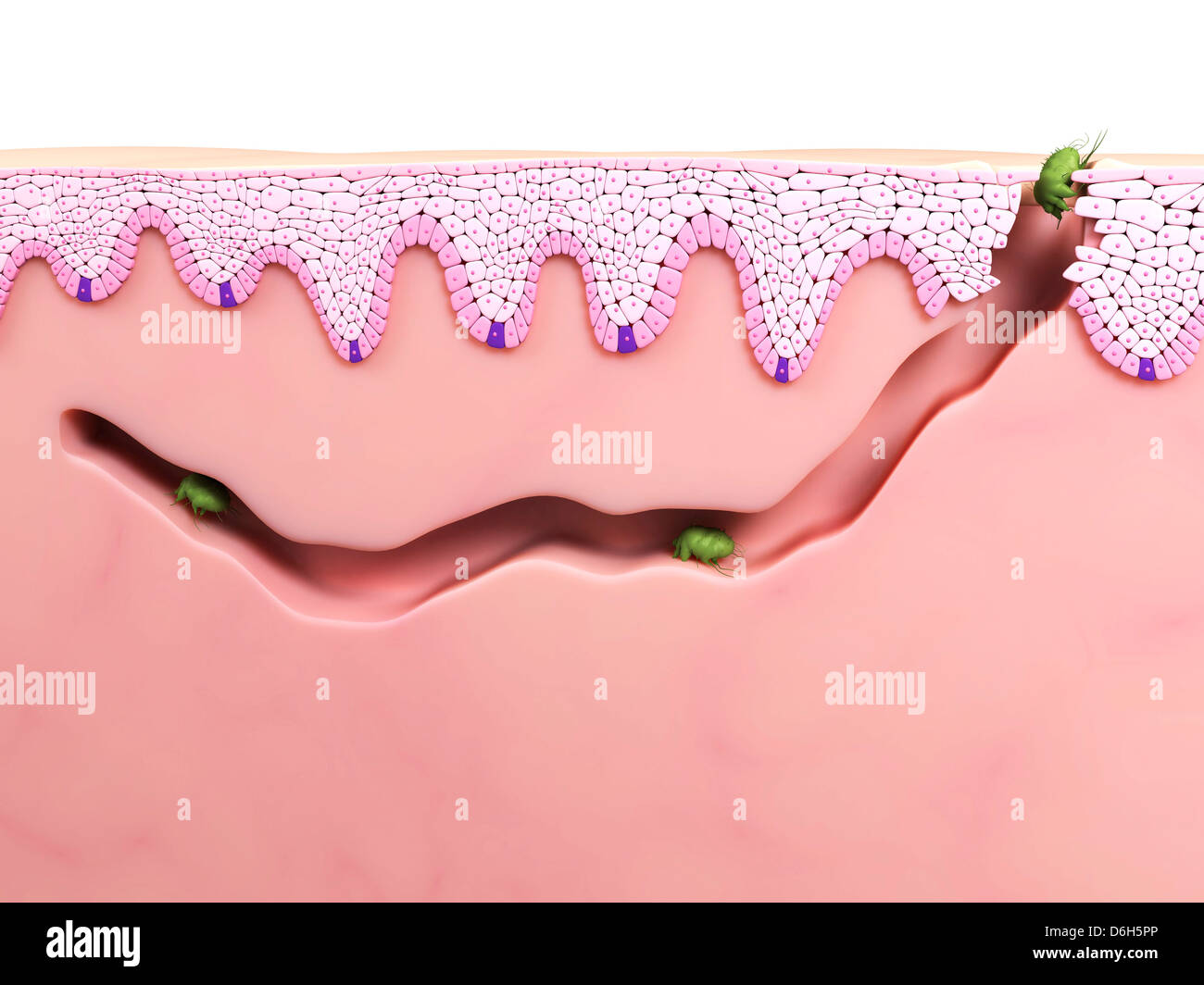 Scabies infection hi-res stock photography and images - Alamy
