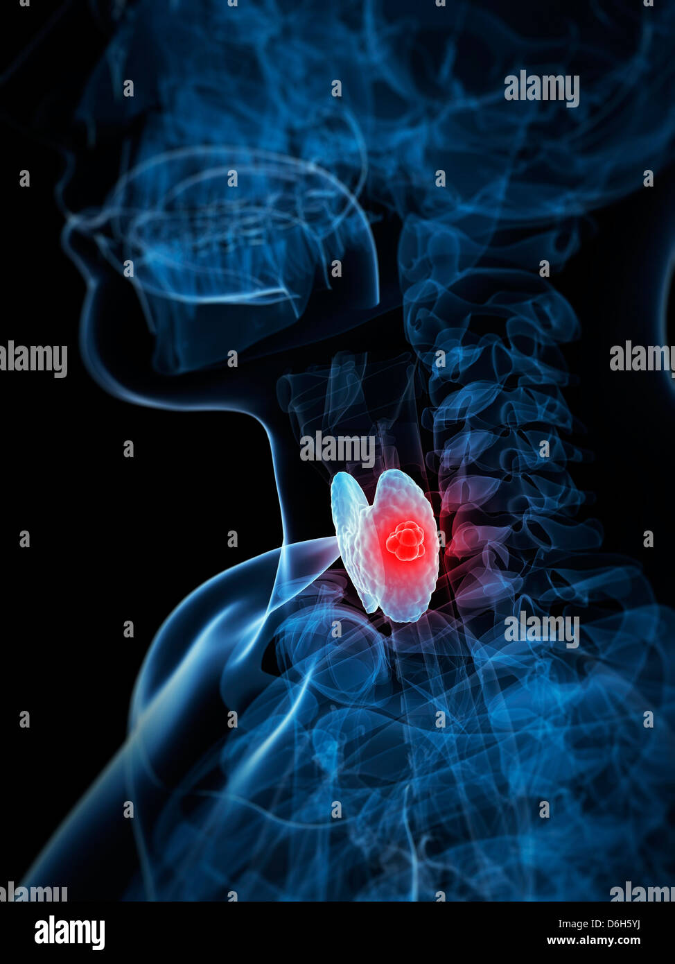 Thyroid cancer hi-res stock photography and images - Alamy