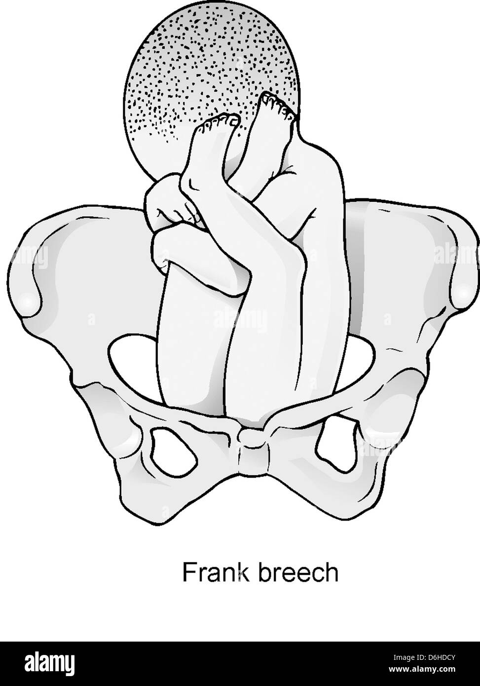 Breech birth hi-res stock photography and images - Alamy