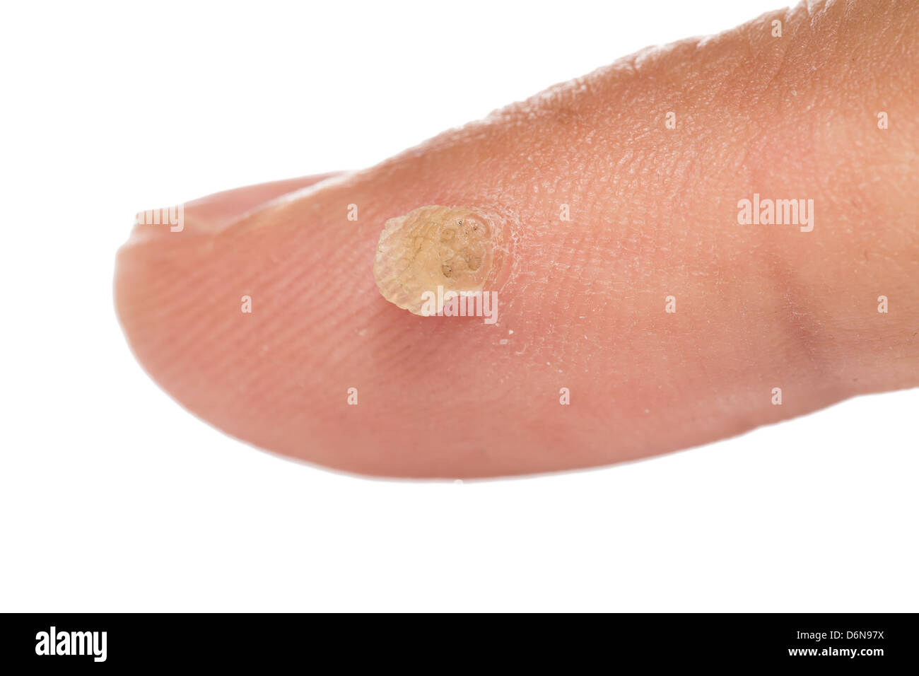 Verruca hi-res stock photography and images - Alamy