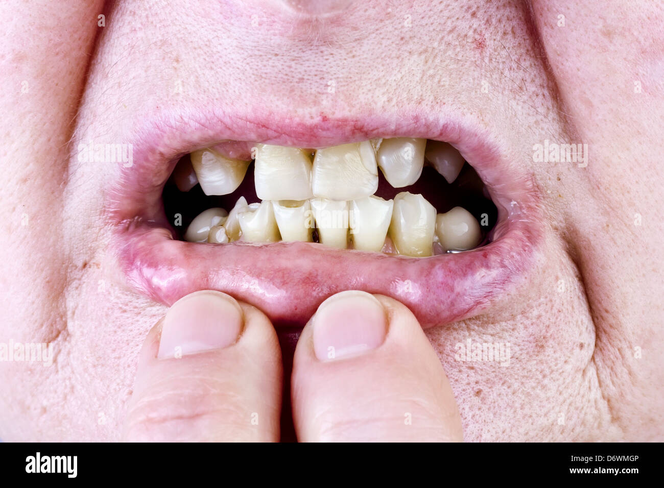 Yellow elderly female teeth and sore lips, large pores on the loose ...