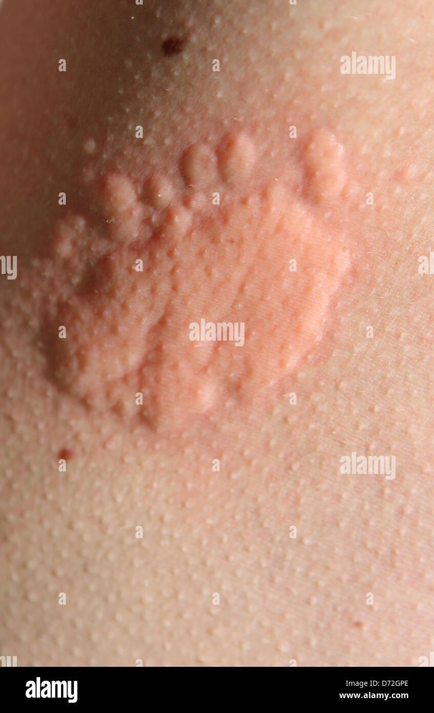 Alicudi, Italy, rash after contact with a jellyfish Stock Photo - Alamy