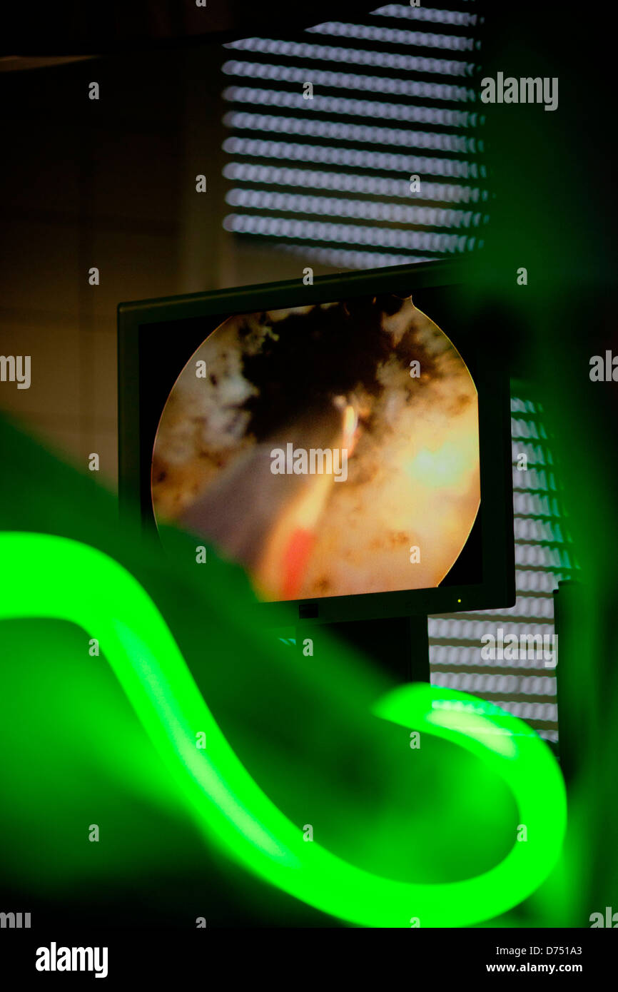 Treatment Benign Prostatic Hyperplasia (BPH) by Photoselective ...