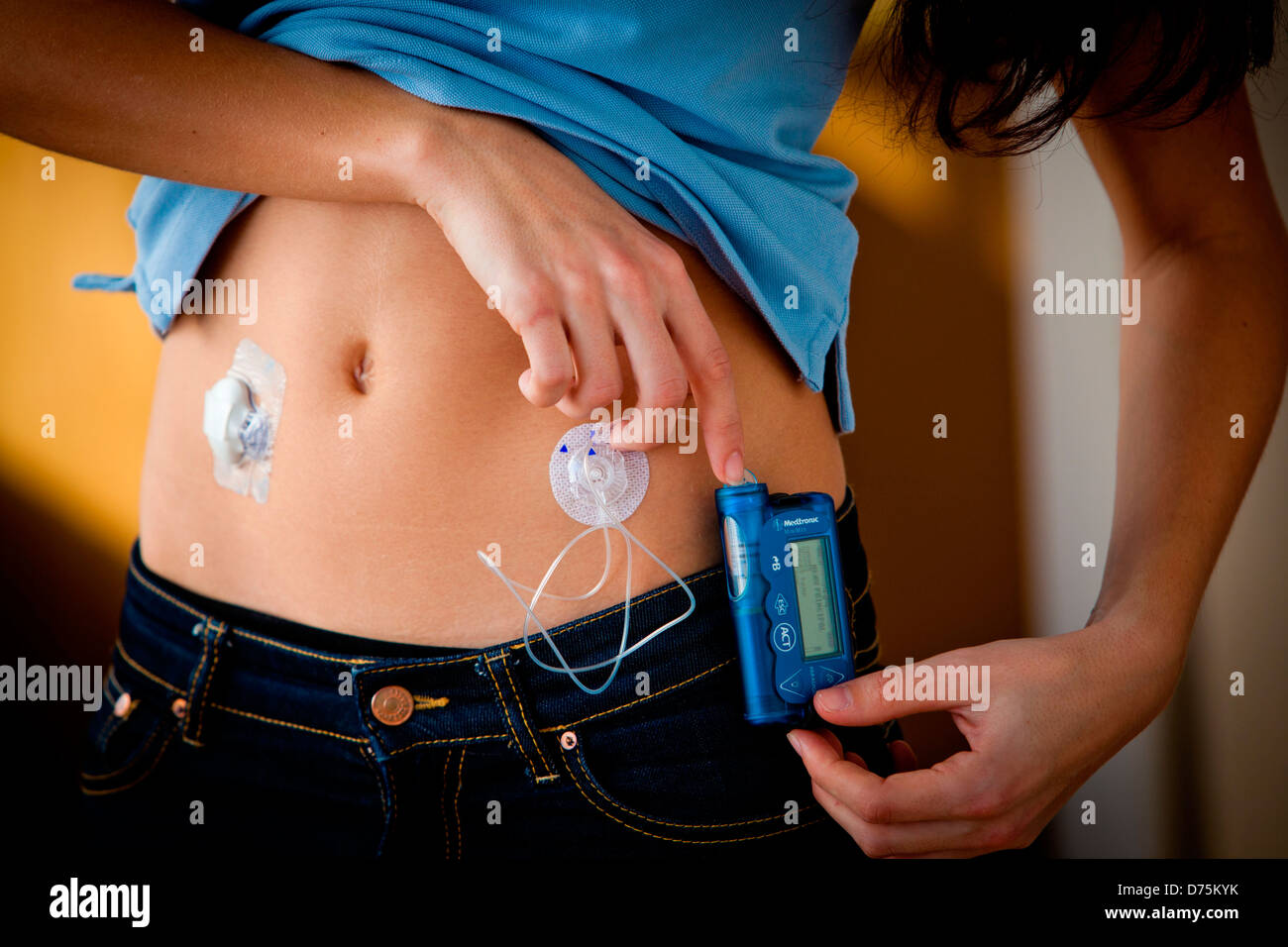 Programmable insulin pump administering insulin continuously through ...