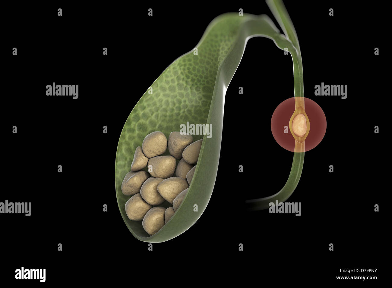 Gallstones Stock Photo: 56149127 - Alamy