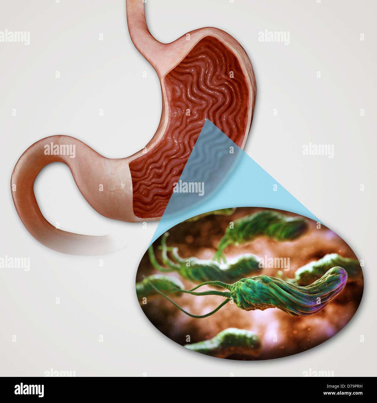 H pylori hi-res stock photography and images - Alamy