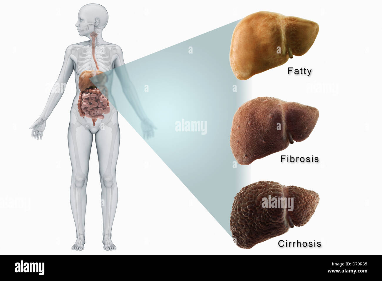 Stages Liver Disease Stock Photo - Alamy