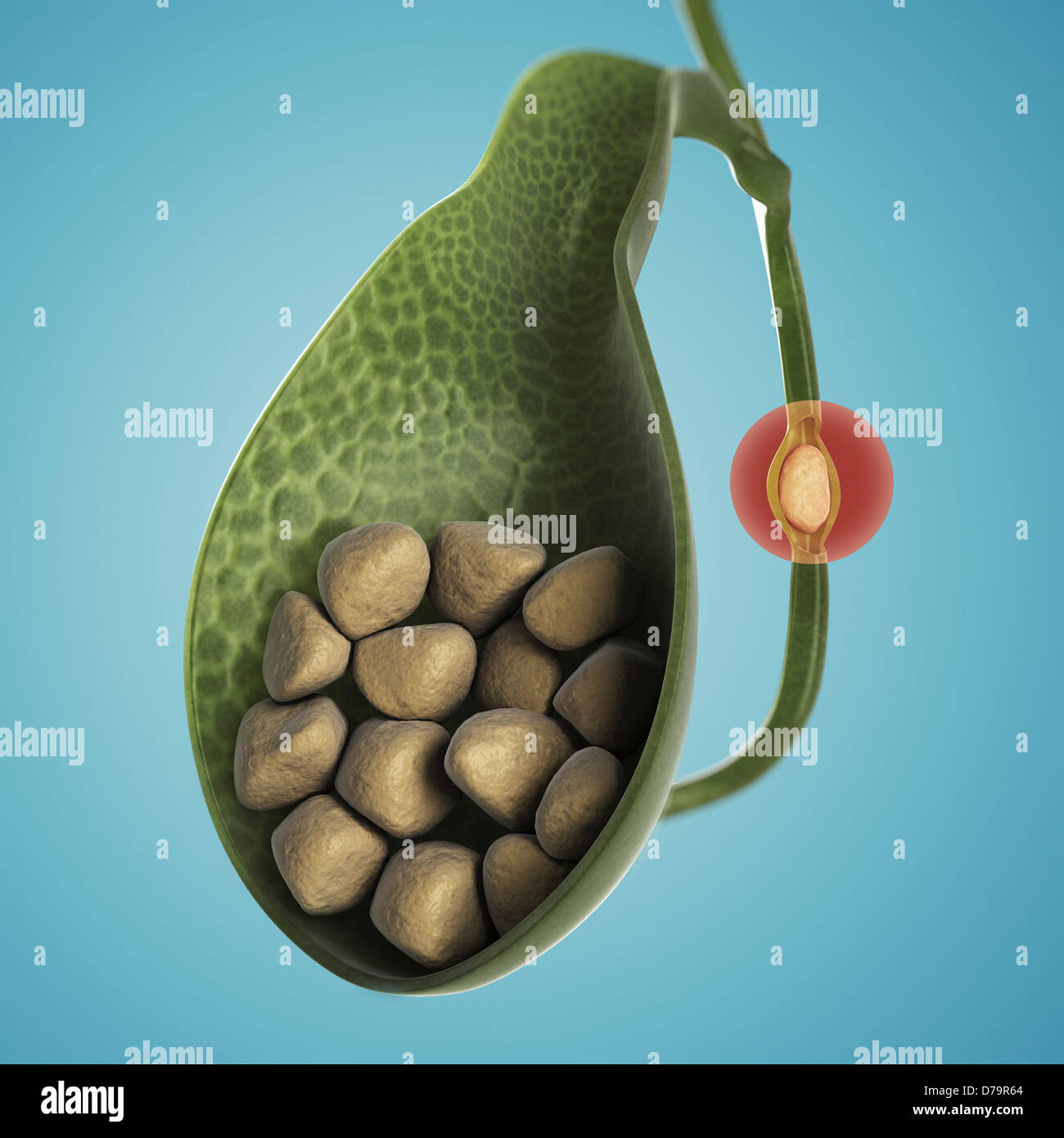 Gallstone anatomy hi-res stock photography and images - Alamy