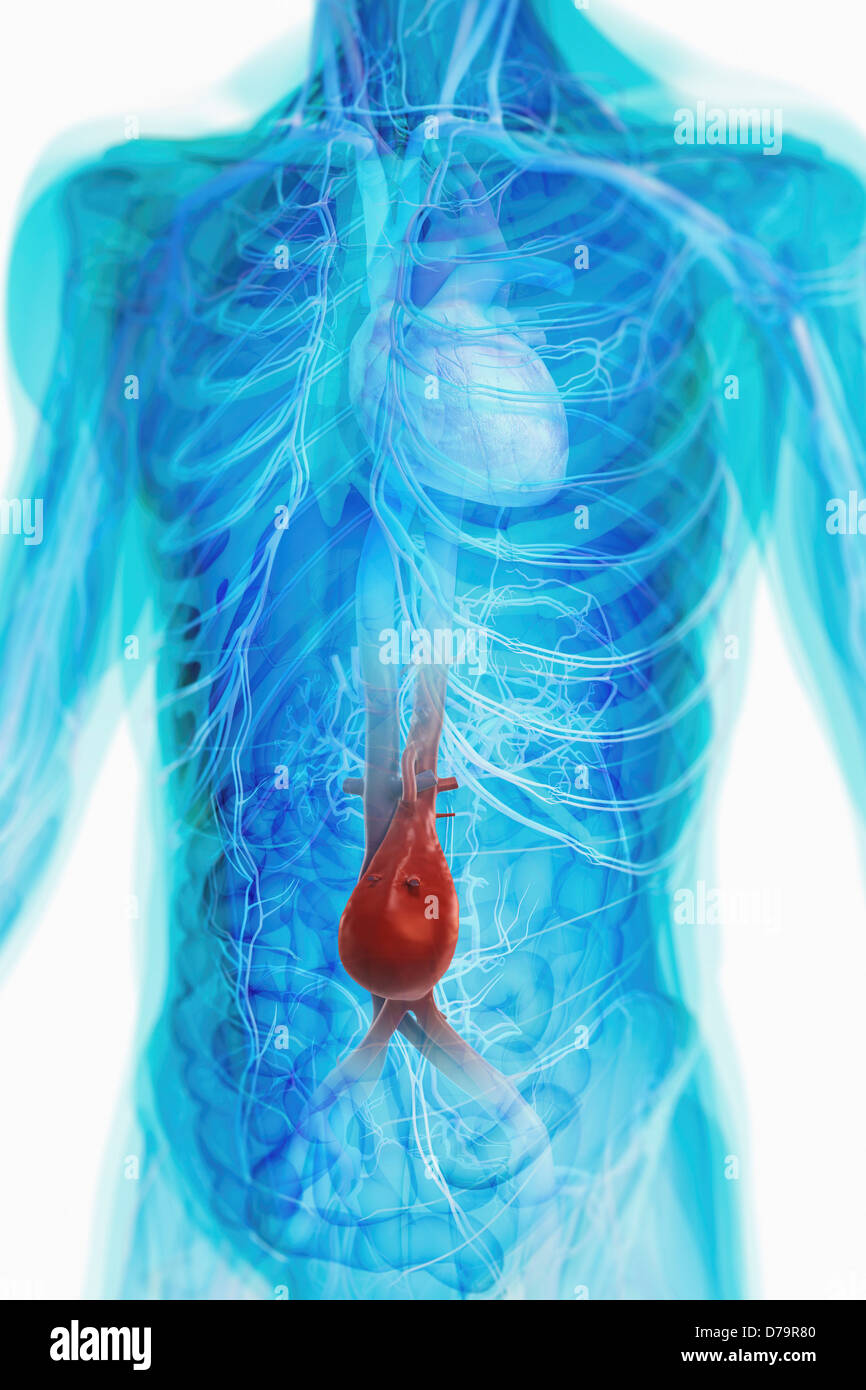 Abdominal aortic aneurysm hi-res stock photography and images - Alamy