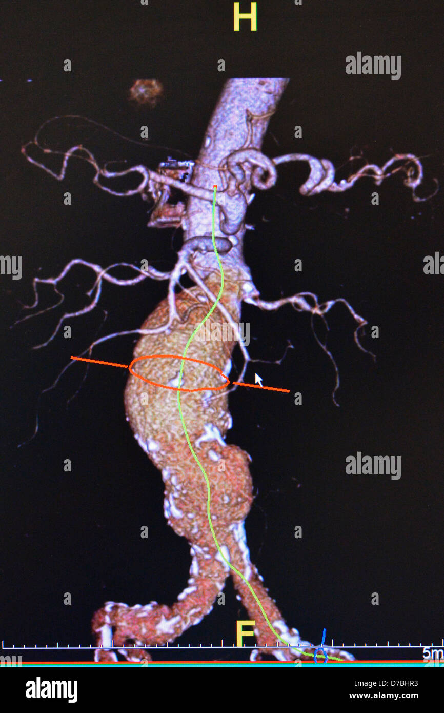 Aortic aneurysm hi-res stock photography and images - Alamy