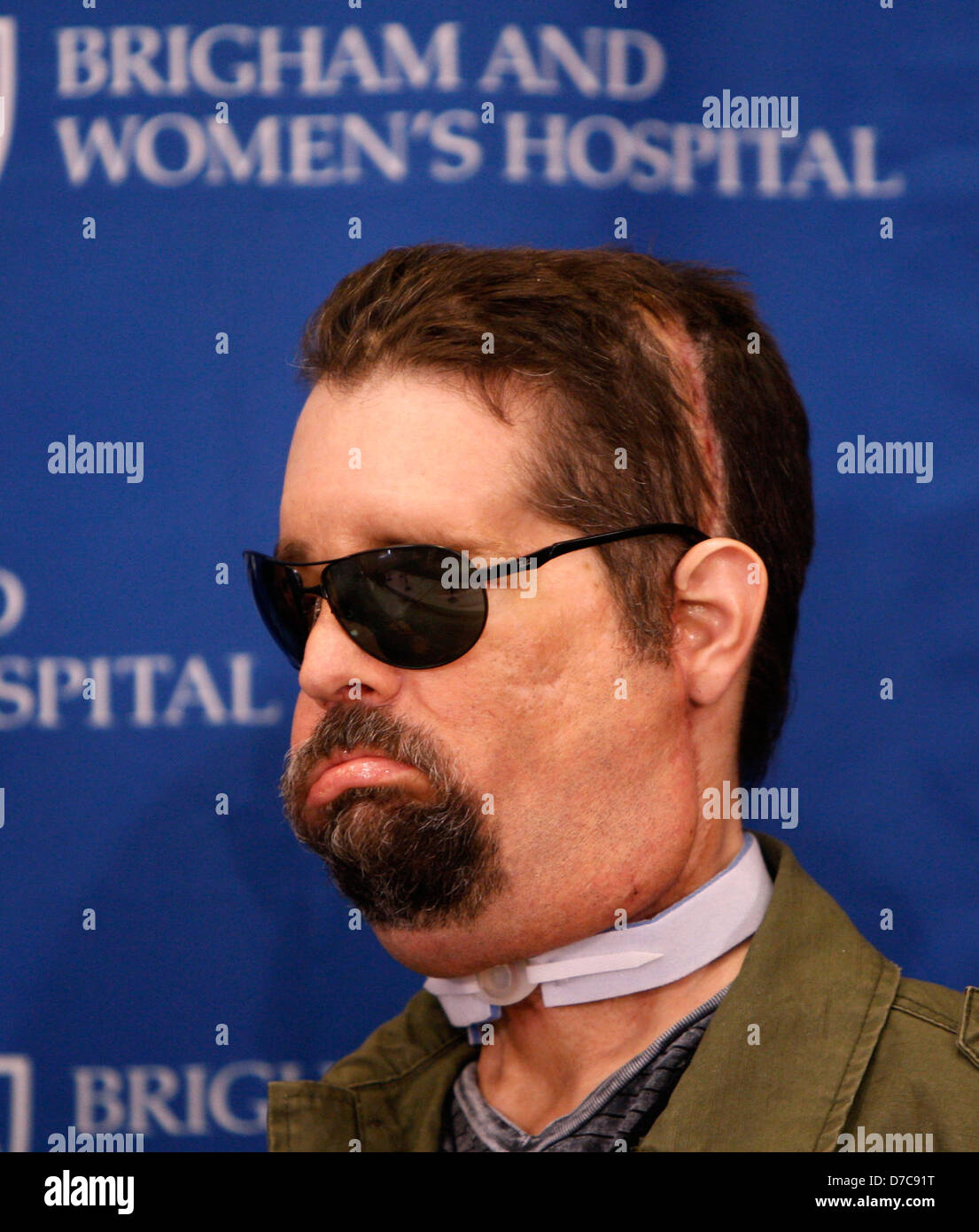 Dallas Wiens face transplant recipient, of Fort Worth, Texas, at a news ...