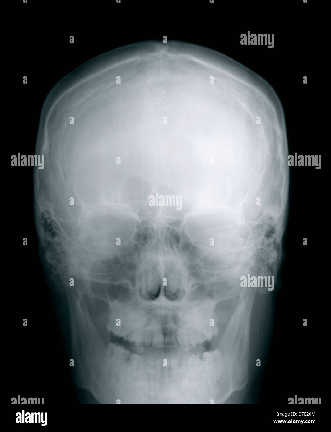 Xray of skull and jaw hi-res stock photography and images - Alamy